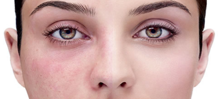 Kas yra veido rožinė (rožė) - Manomedicina.lt